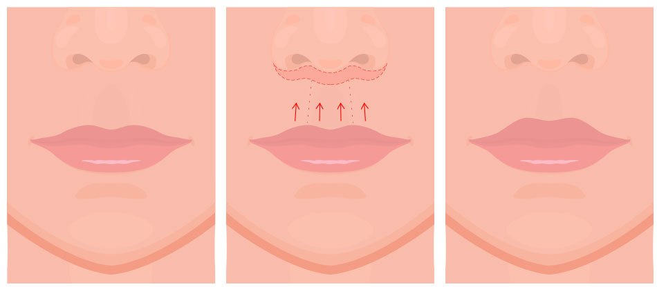 Lip Lift Toronto - Facial Surgeon - Cosmedical Rejuvenation Clinic
